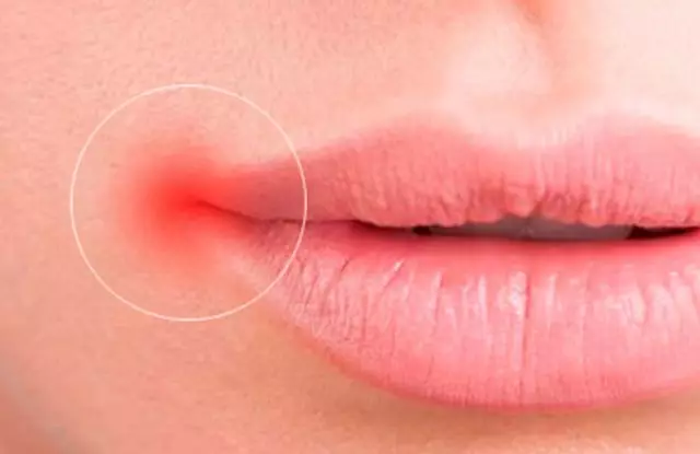 Cracks in the corners of the lips